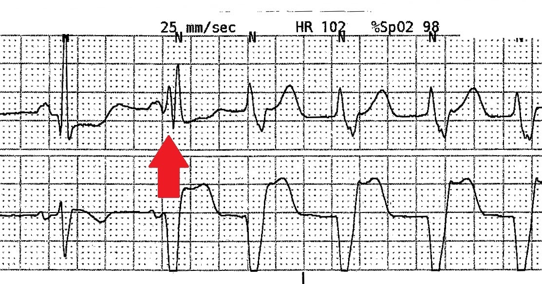 ECG Rhythms: The Fusion is the Clue