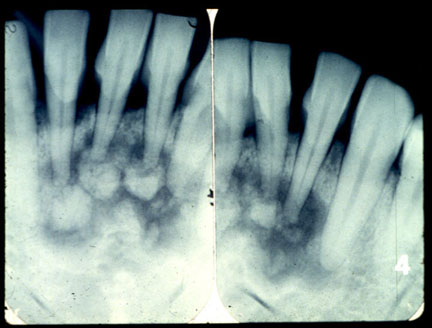 WizDent: Periapical Cemental Dysplasia