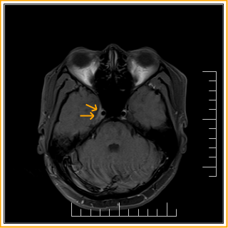 Tolosa-Hunt Syndrome-MRI - Radiology Imaging