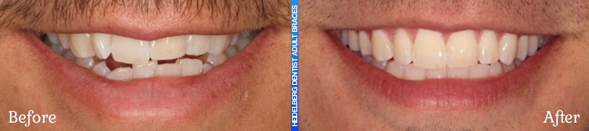 Adult Braces - Teeth Straightening With Orthodontics For Adults ...