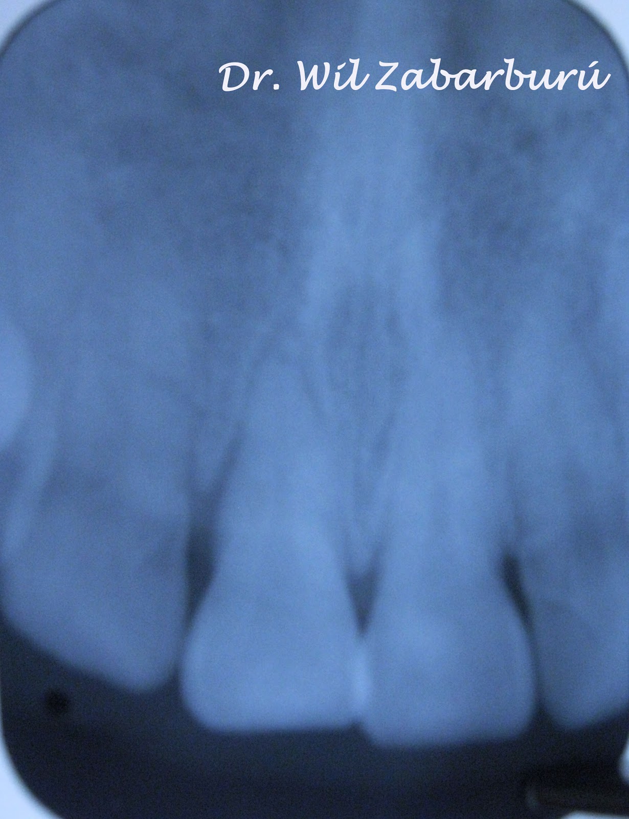 CLINICA DENTAL ASISTENCIAL: LACERACIÓN LABIAL Y TRAUMA DENTARIO