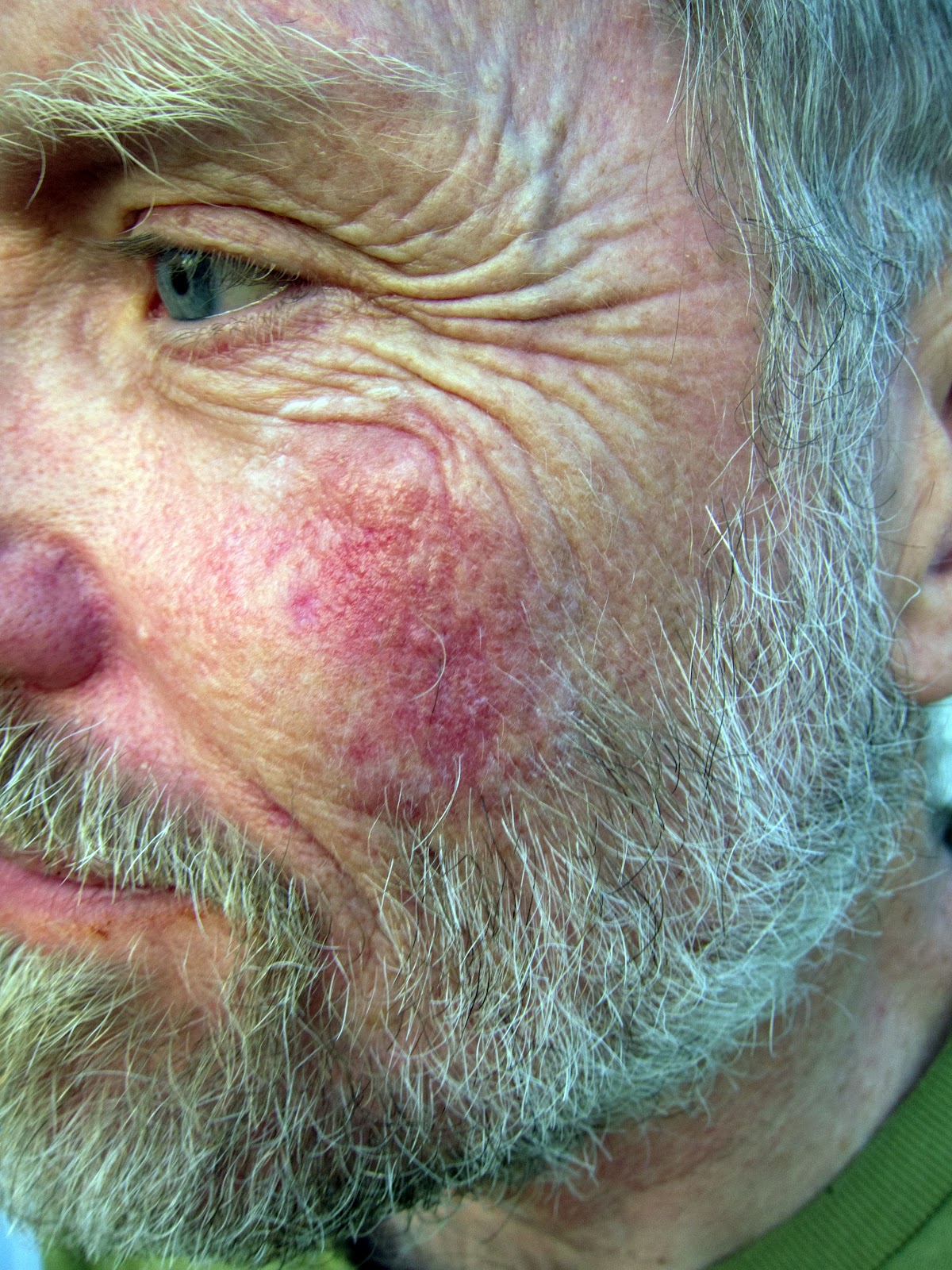 Efudex - Round Two: March 2012