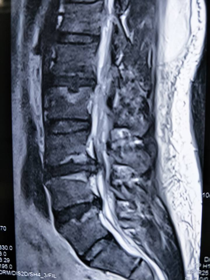 Kesakitan Anda Keutamaan Kami: Injection laser PLDD for lumbar slipped ...