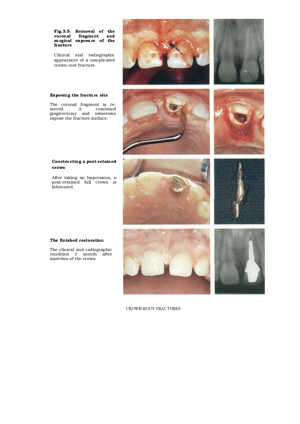 DOs and DONTs in DENTISTRY: CROWN ROOT FRACTURES