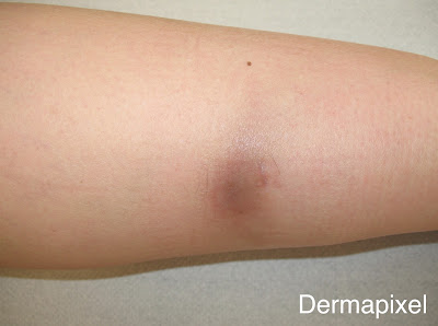 Dermapixel: marzo 2018