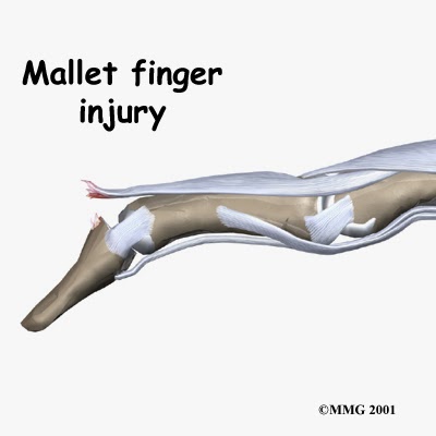 Desh Raj Sonyok: Recovery of My Mallet Finger Injury in Judo Training