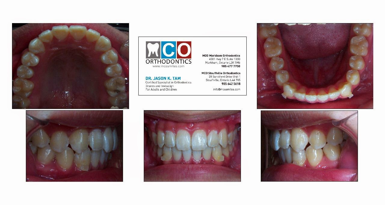 Your Markham Orthodontist, Toronto Invisalign, and Richmond Hill Braces ...
