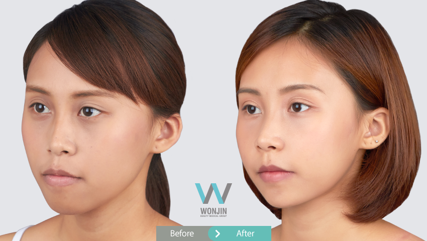 Operasi Dua Rahang, Penting untuk Memperbaiki Sisi Fungsionalnya