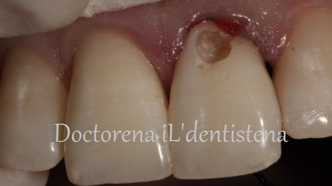 My Dental Diary: Class V restoration - Operative