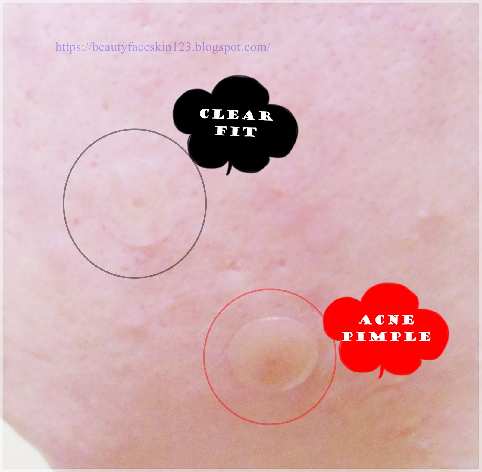 GREAT SKINandLIFE: REVIEW ON COSRX CLEAR FIT MASTER PATCH VS COSRX ACNE ...