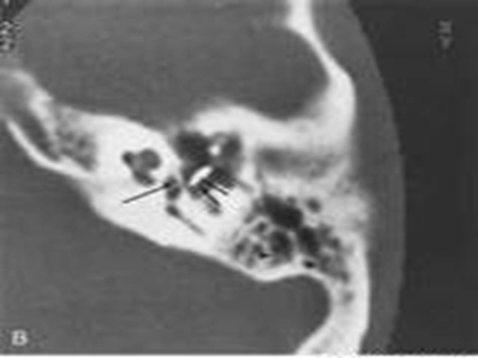 Pyothorax Without Fistula