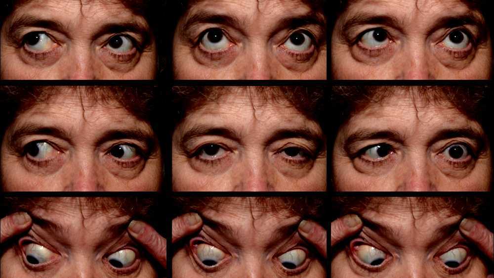 Oculomotor nerve palsy