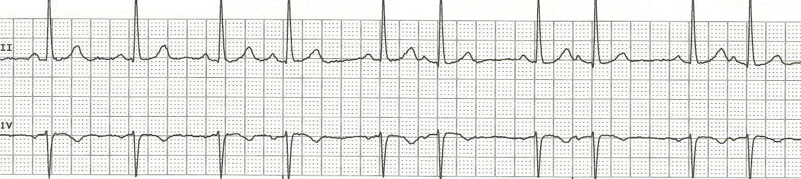 EKG Rhythm Strip Quiz 84