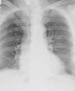 Trachea on CXR-Patient with Stridor - Sumer's Radiology Blog