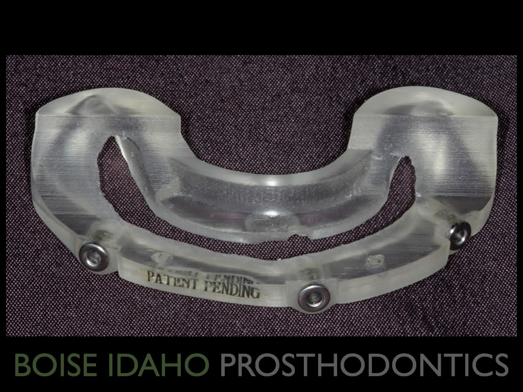 Boise Idaho Prosthodontics: CBCT Guided Implant and Bone Reduction ...