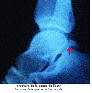 Un médecin du sport vous informe: Microtraumatologie de l'Astragale
