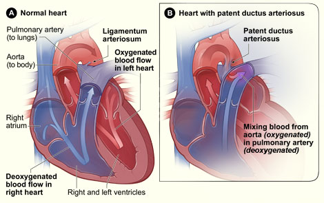 Preemie Resource Blog: PDA-Patent Ductus Arteriosus