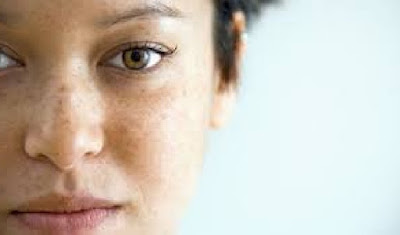 5 Bahan Alami Untuk Menghilangkan Bintik Hitam di Wajah