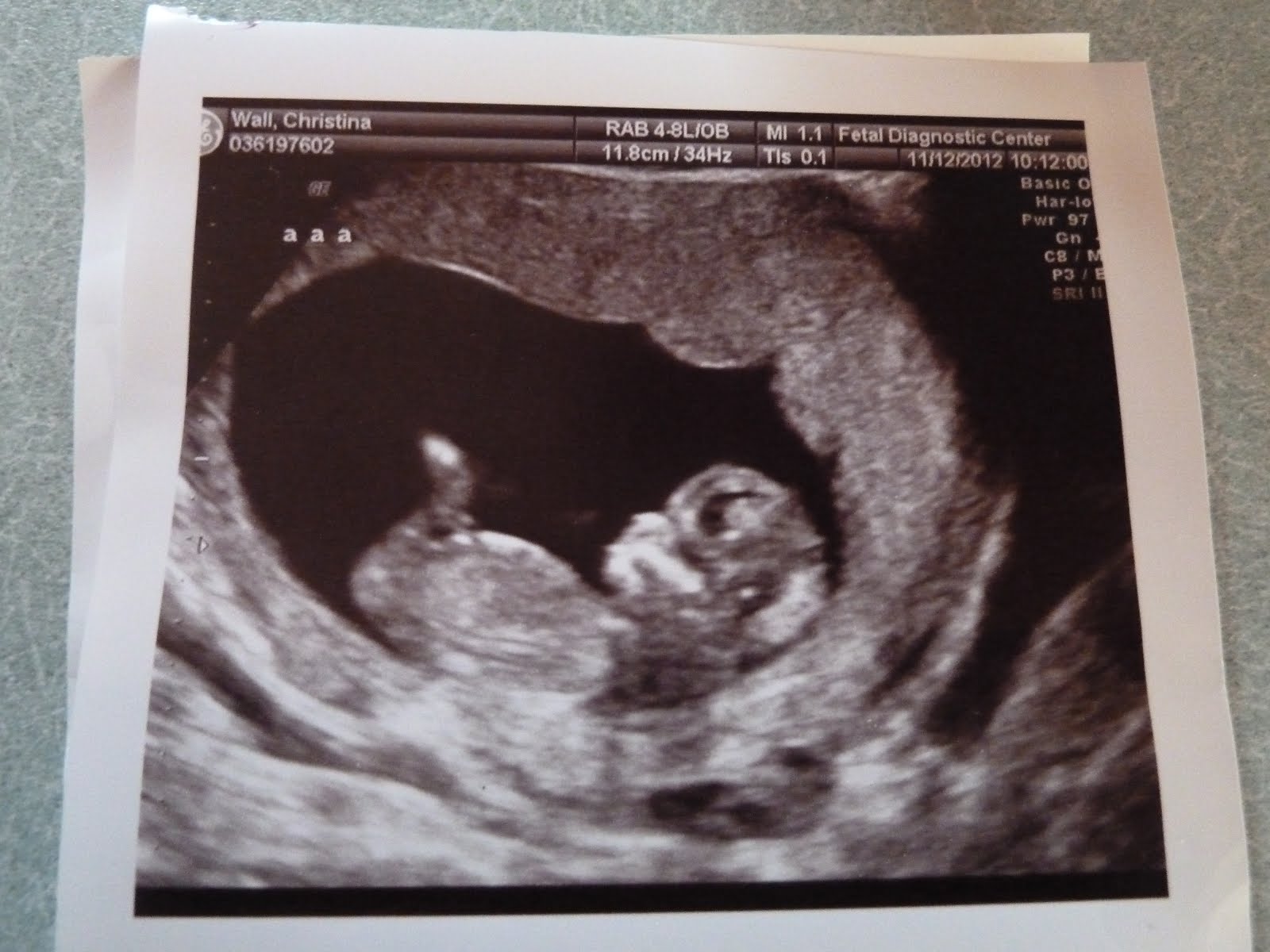 Baby Bitty Twins: NT Scan pics and Emmeline's birthday party