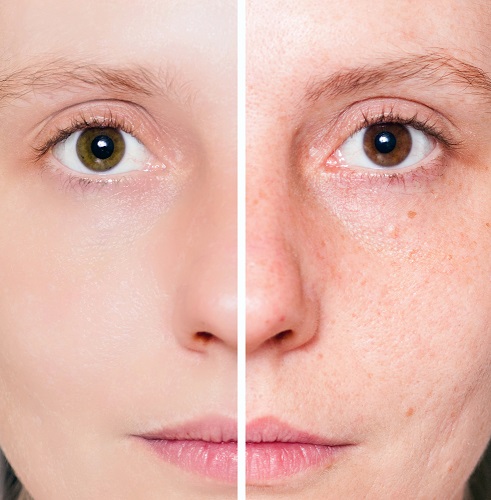 Acne Rosacea y la Cura Definitiva | Que funciona para la Rosacea?