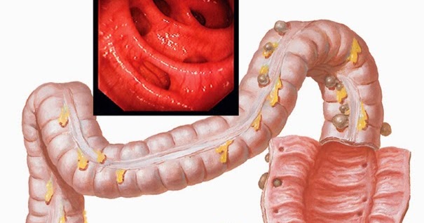 Things You Need to Know About Colorectal Surgery....: Things You Need ...