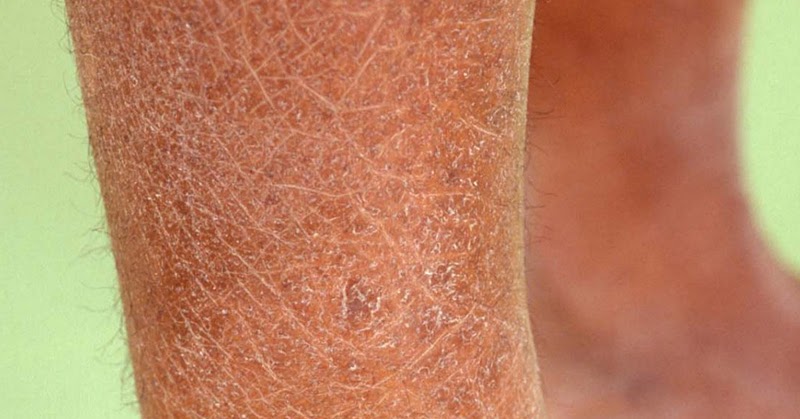 What Is Xerosis? - Teroes