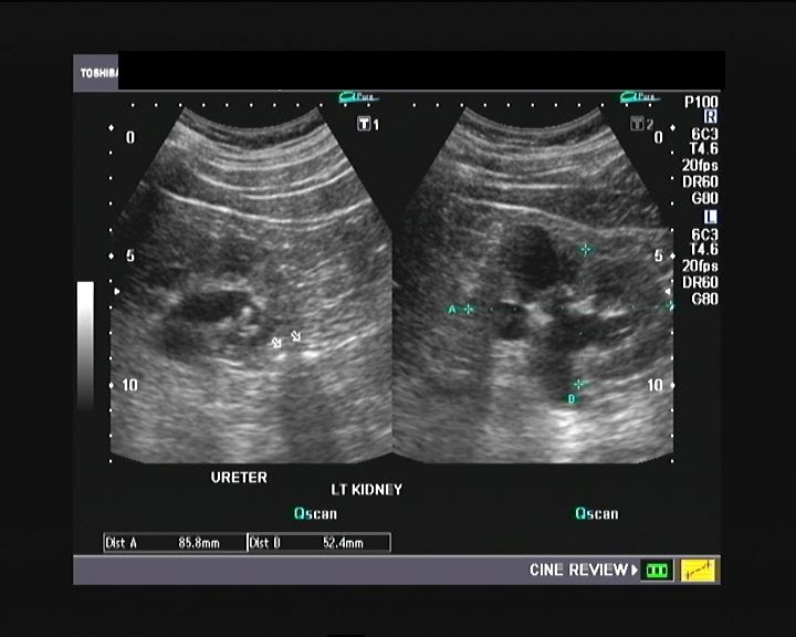 Ultrasound imaging: Left ureteral calculi with hydronephrosis