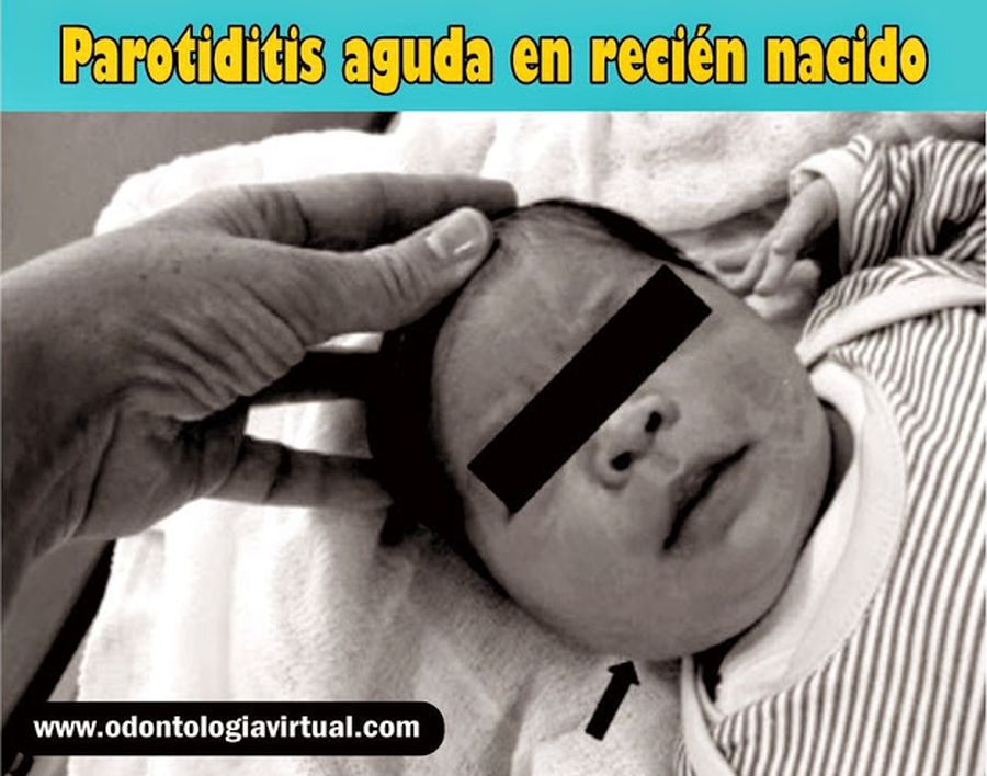 PDF: Parotiditis aguda en recién nacido - Ovi Dental