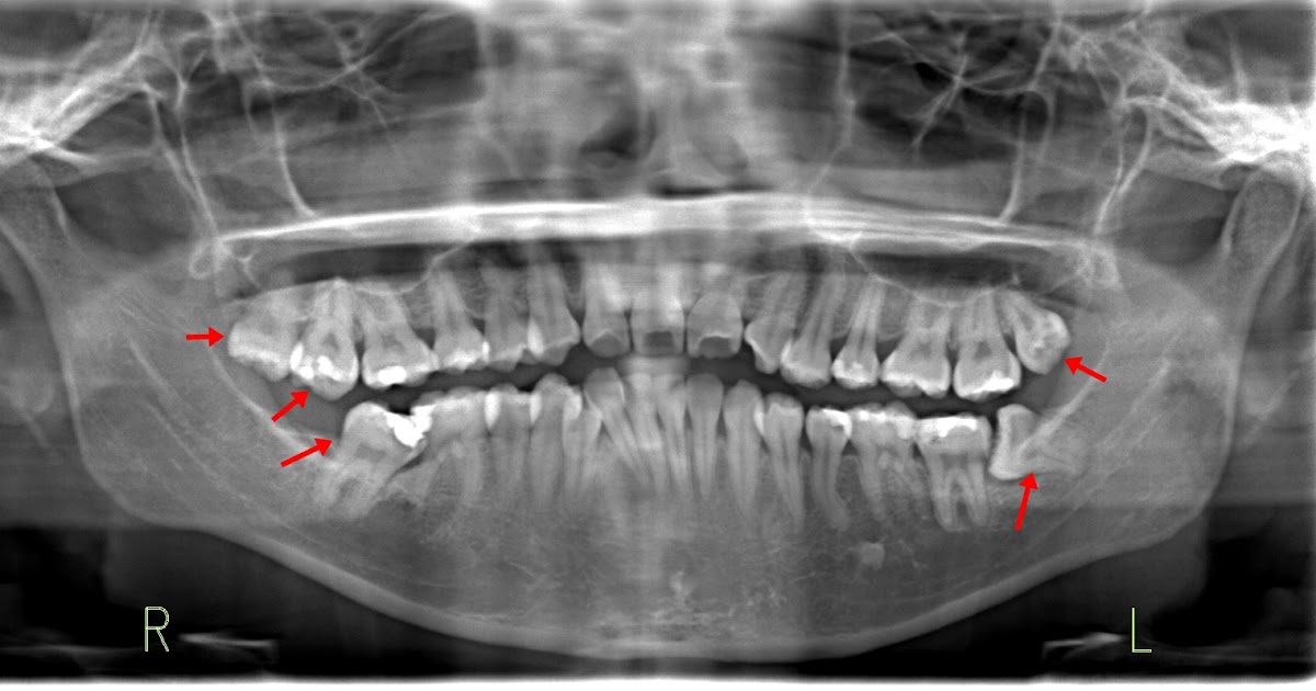 Wisdoms and Molars