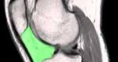 FISIOTERAPEUTAS: La enfermedad de Hoffa