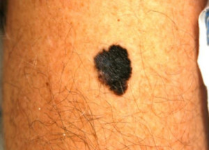 ASK DIS: Maculopapular Rash : Diagnosis