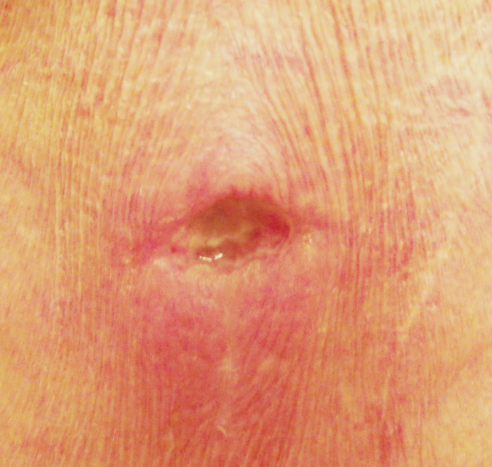 How a Tracheostomy Hole Heals Closed (Time Lapse) | Fauquier ENT Blog