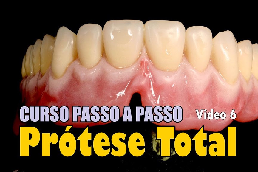ACABAMENTO PRÓTESE TOTAL: Curso passo a passo - Video 6