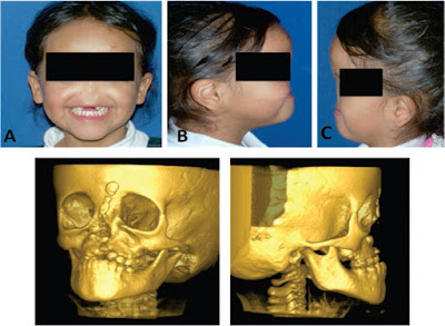 Prótesis nasales: alternativa de manejo para casos especiales ...