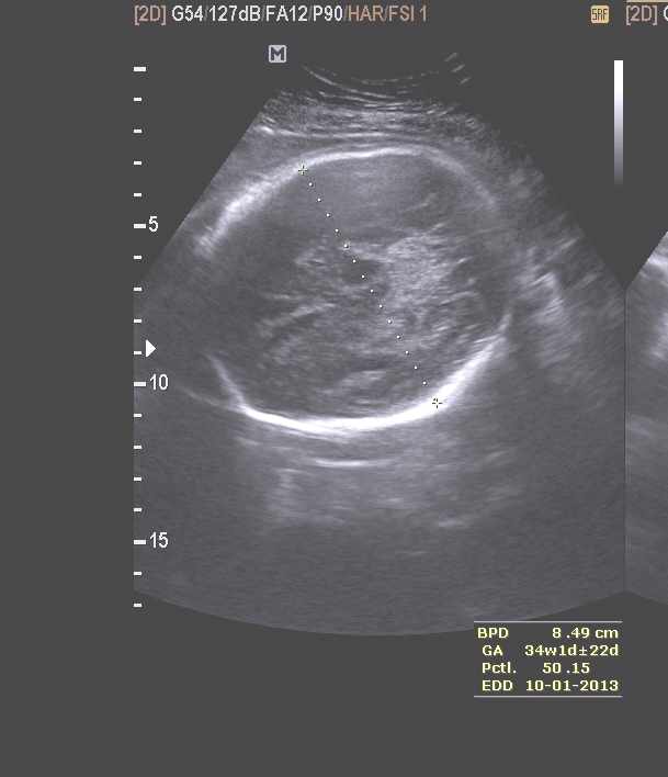 BILIK SONOGRAFER : USG Trimester 2/3
