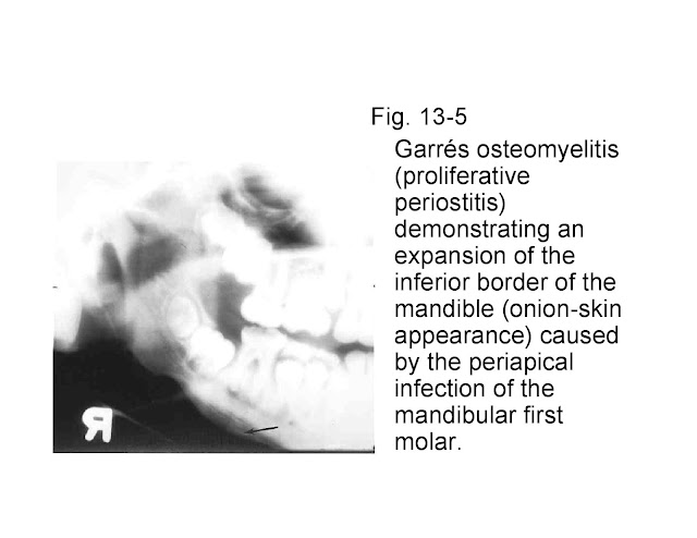 Dentistry and Medicine: Osteomyelitis-with Radiological features