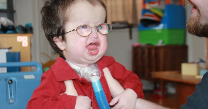 Journals and Conferences on Neurology: Hallermann Streiff Syndrome-The ...