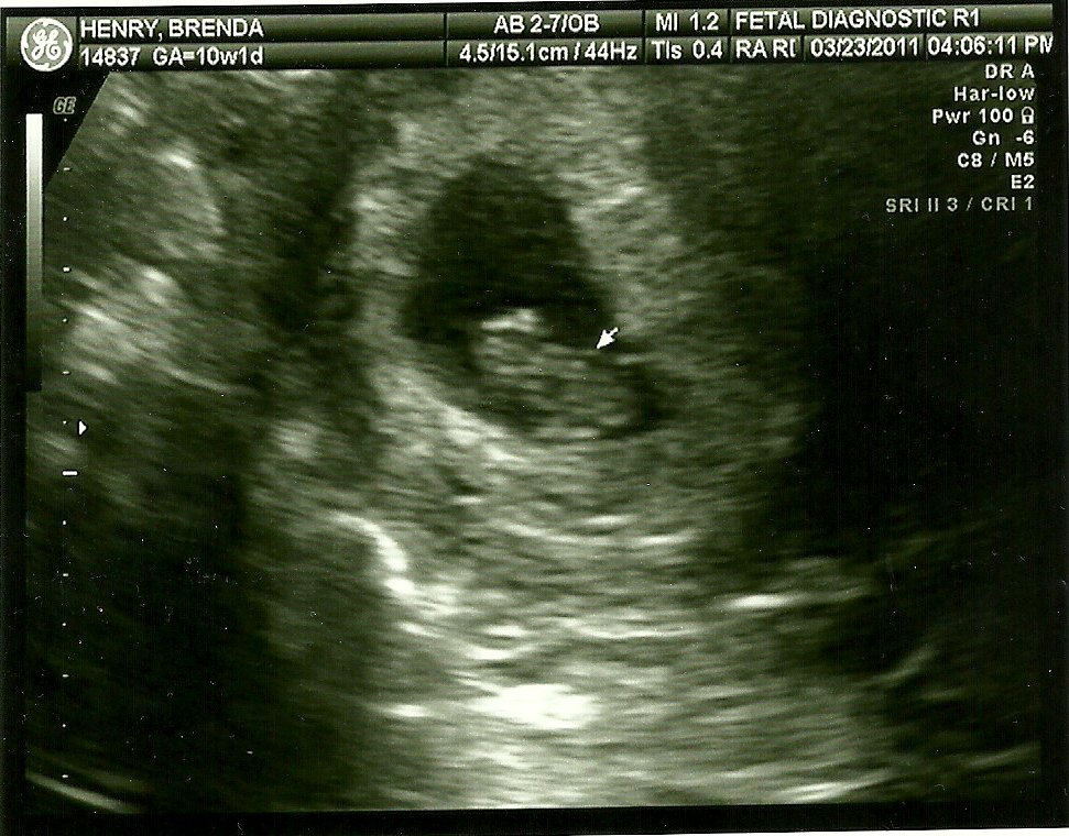 Henry Family... Party of four!: Baby Ultrasound photos