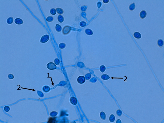 Fun With Microbiology (What's Buggin' You?): Scedosporium prolificans