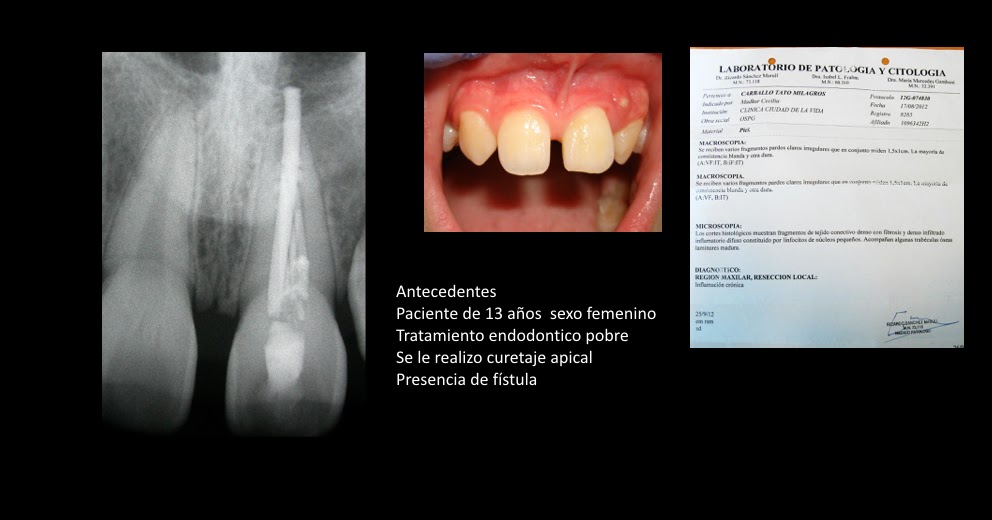SECCION PARA ALUMNOS ENDODONCIA II : Retratamiento en 2.1