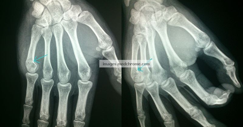 Boxer's fracture: Fracture of neck of 5th metacarpal | Medchrome Images