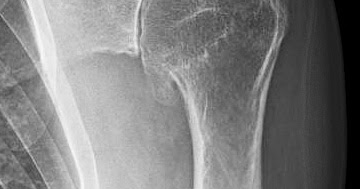 UW Shoulder and Elbow Academy: Ream and run, first three months.