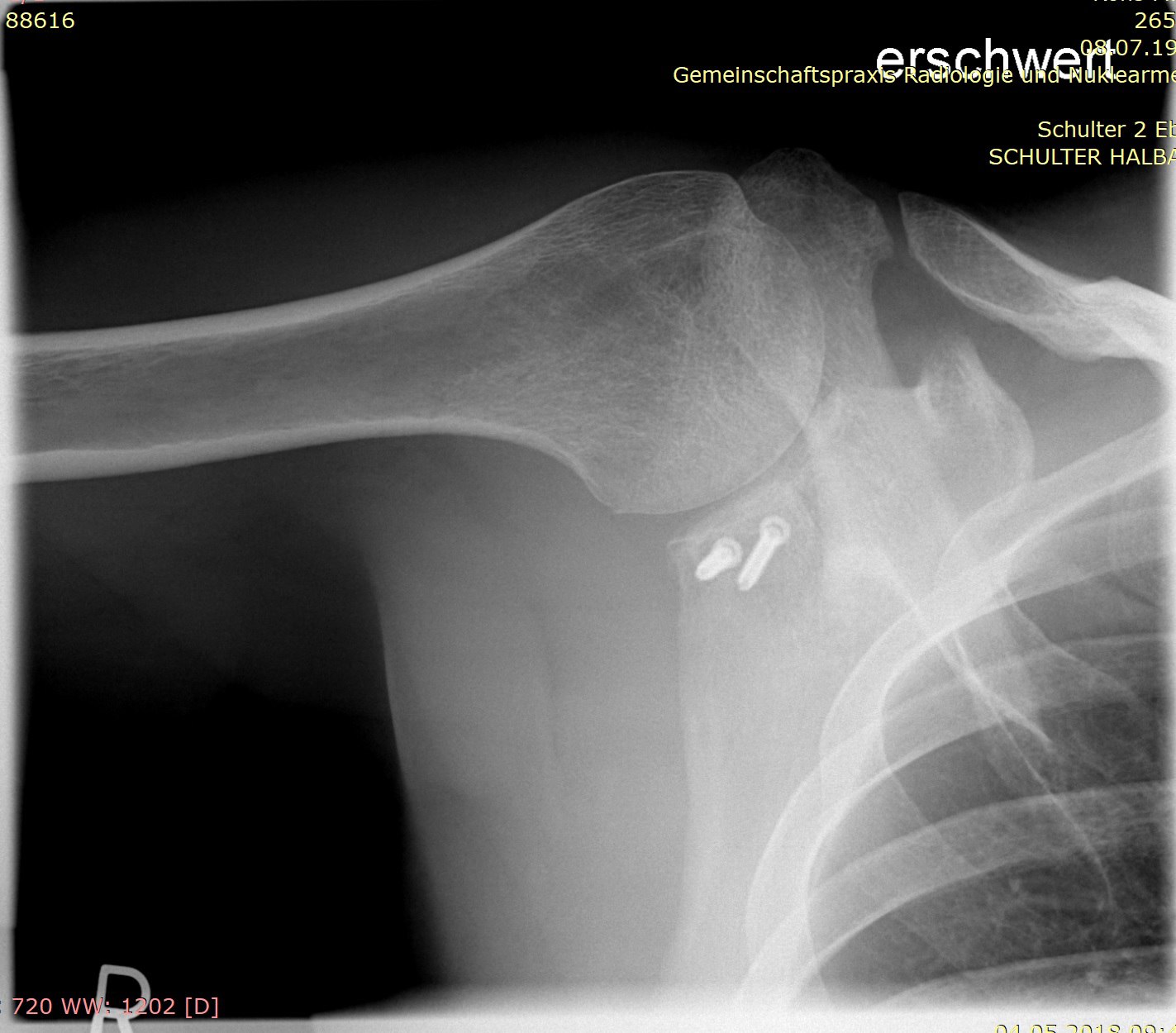 Eight weeks post Latarjet surgery - Follow up examination