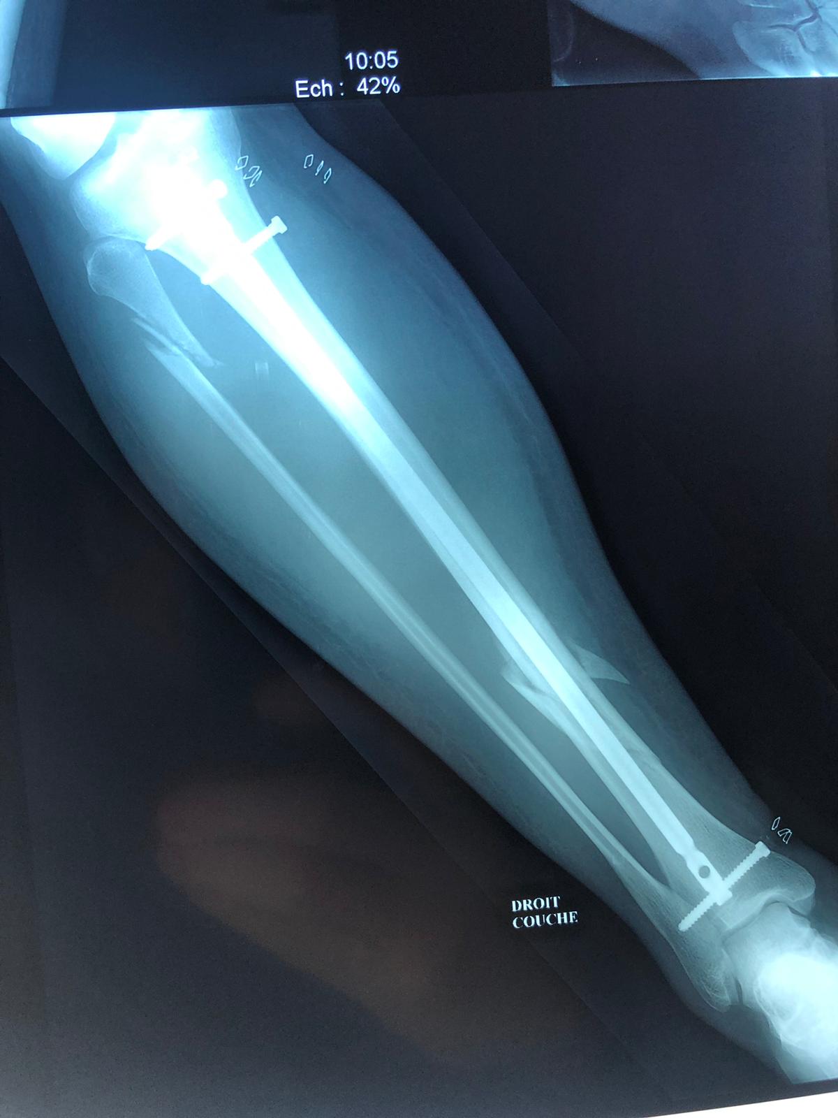 Ski Injury - A Broken Leg in France - Intramedullary Rod
