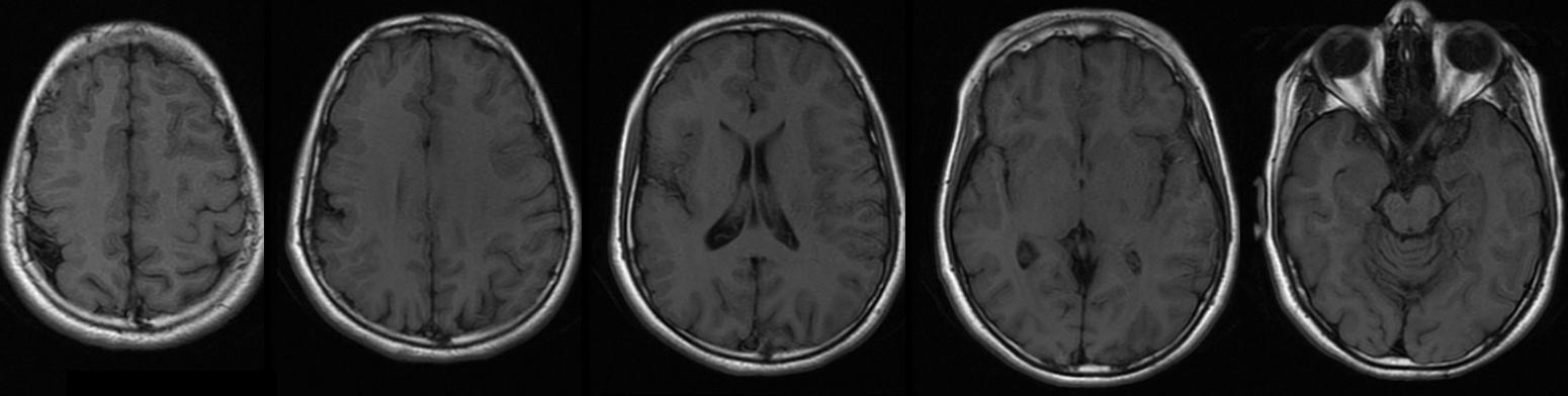 Dr Balaji Anvekar FRCR: Polymicrogyria MRI