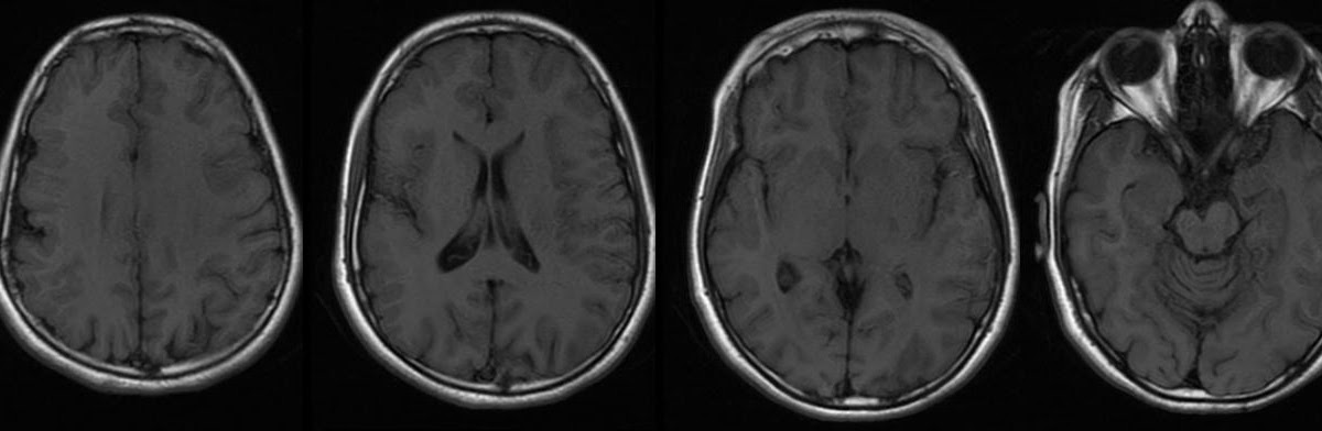 Dr Balaji Anvekar FRCR: Polymicrogyria MRI