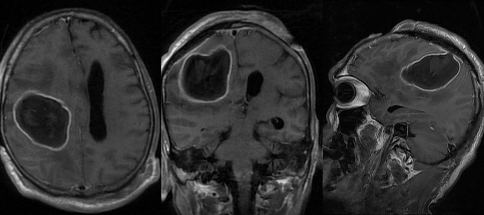 Brain abscess - Pictures