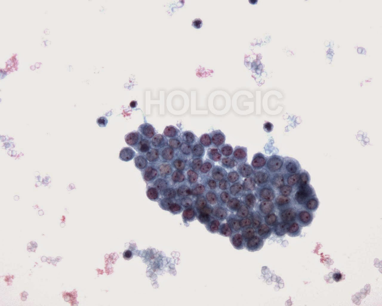 Anatomía patologica: derrames serosos