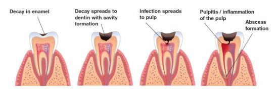 CAVITY!! what it is all about?
