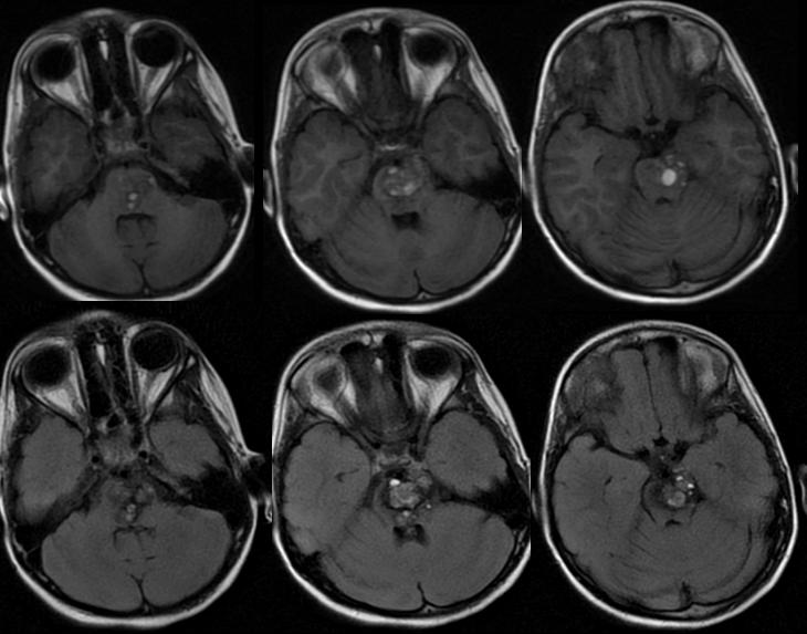 Dr Balaji Anvekar FRCR: Cavernoma with Venous Angioma